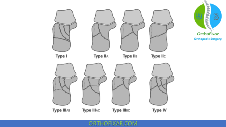 Calcaneus Fracture (Heel Fracture) | OrthoFixar