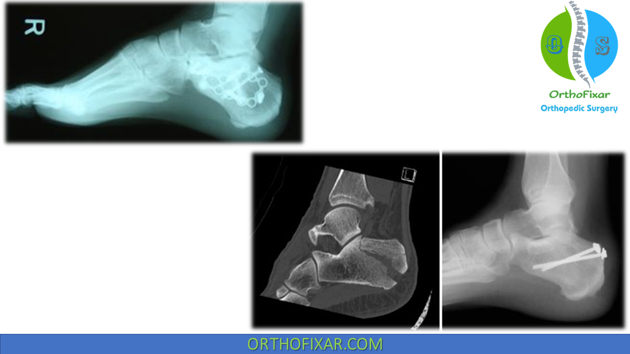 Calcaneus Fracture (Heel Fracture) | OrthoFixar