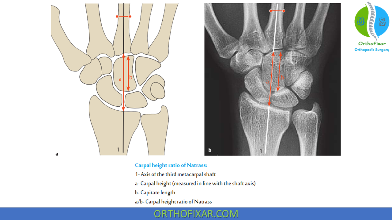 Ulnar Variance | Negative, Positive & Normal Values Explained Easily ...