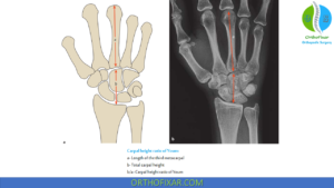 Ulnar Variance | Negative, Positive & Normal Values Explained Easily ...