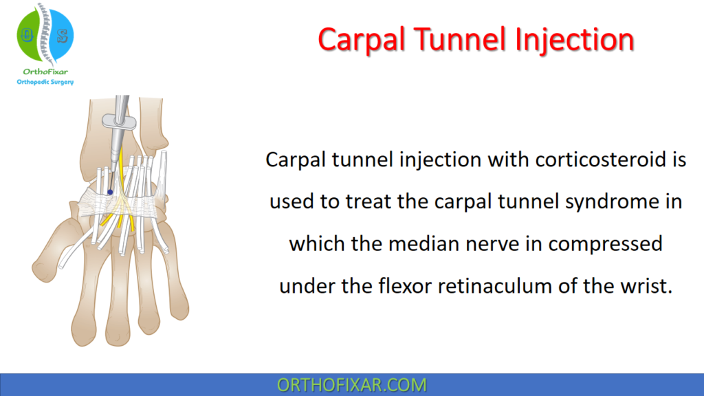 Carpal Tunnel Injection Easily Step-By-Step | OrthoFixar