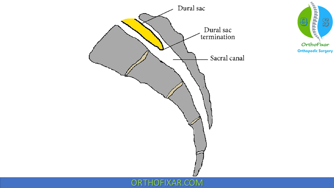Caudal Epidural Injection Overview | OrthoFixar 2026