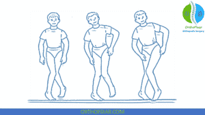 Cerebral Palsy Spasticity Scales Explained Easily | OrthoFixar