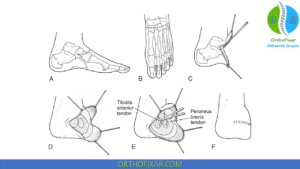 Chopart Amputation Easily Step-By-Step | OrthoFixar