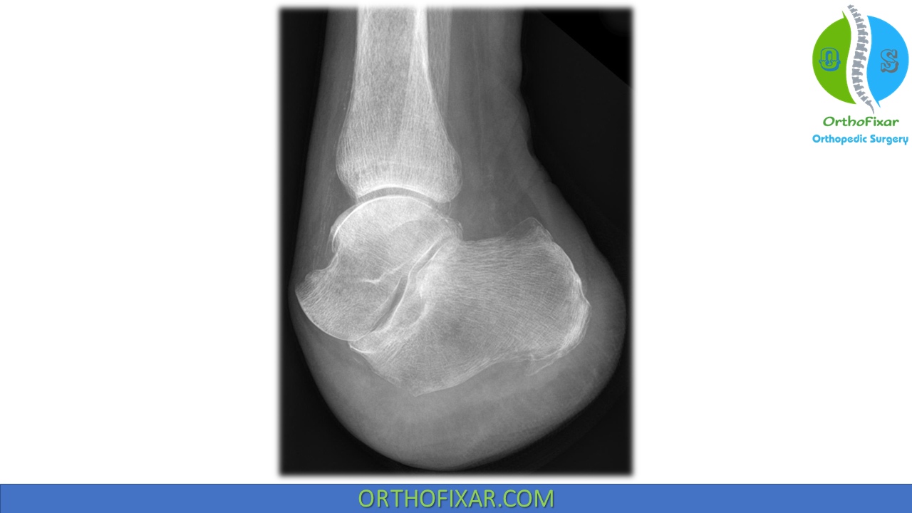 Chopart Amputation Easily Step-By-Step | OrthoFixar