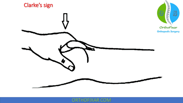 Patellofemoral Pain Syndrome Overview | OrthoFixar 2025