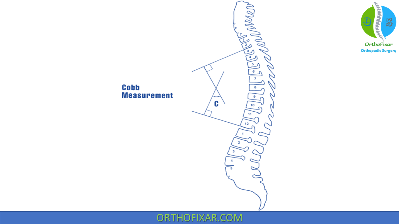 Cobb Angle For Scoliosis | OrthoFixar 2025