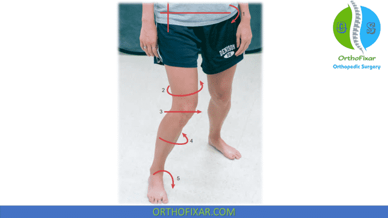 Patellofemoral Pain Syndrome Overview | OrthoFixar 2026