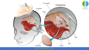 Skull Fracture Overview & Treatment