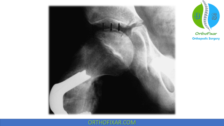 Legg-Calvé-Perthes Disease | OrthoFixar 2025