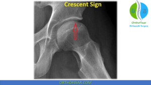 Osteonecrosis Of The Hip - Easy Explained | OrthoFixar 2026