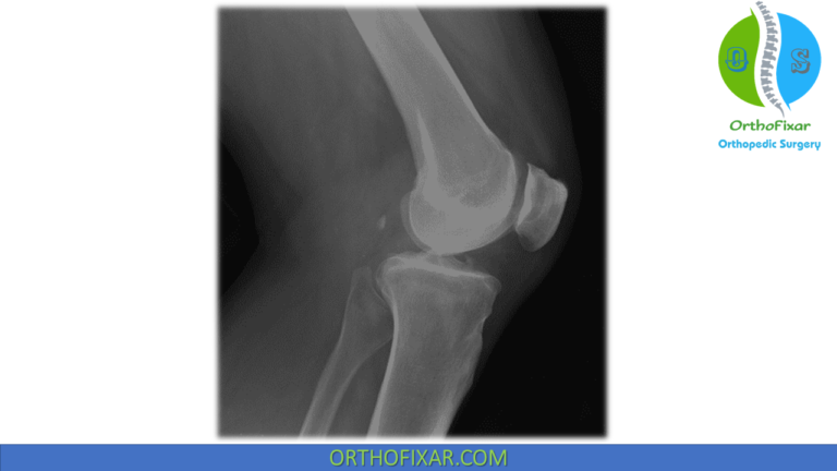 Patellar Instability - Easy Explained | OrthoFixar 2026