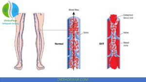 Deep Venous Thrombosis (DVT) | OrthoFixar 2025