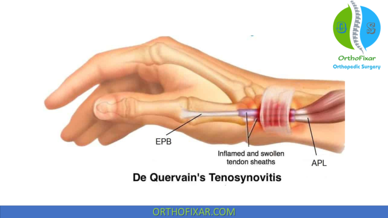 Green Classification Of Trigger Finger | OrthoFixar 2025