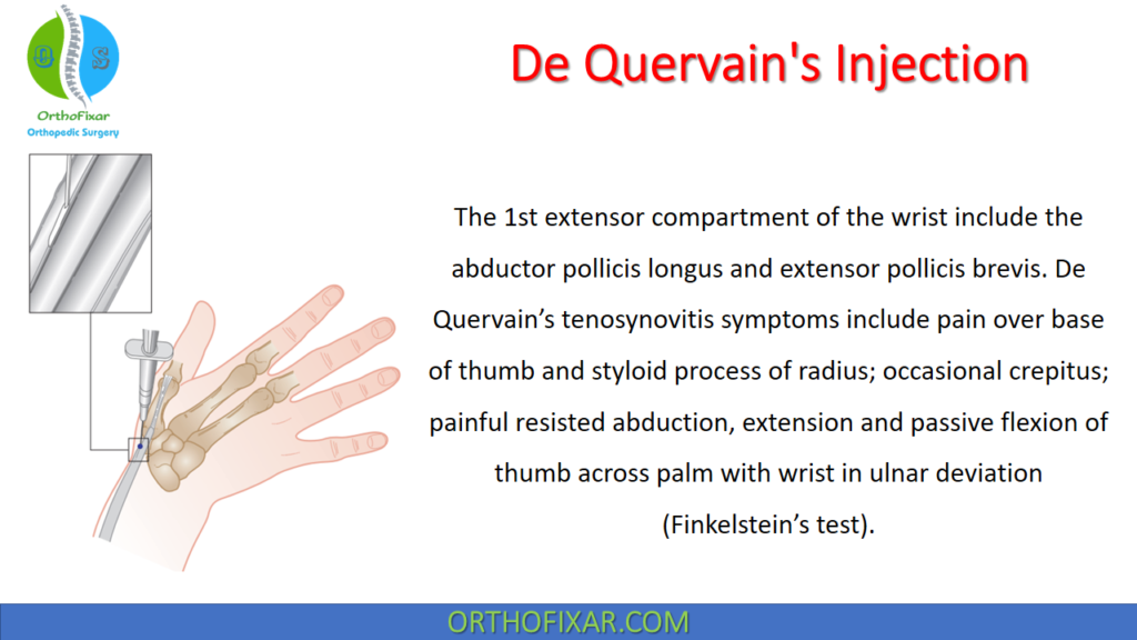 De Quervain's Injection Easily Step-By-Step | OrthoFixar