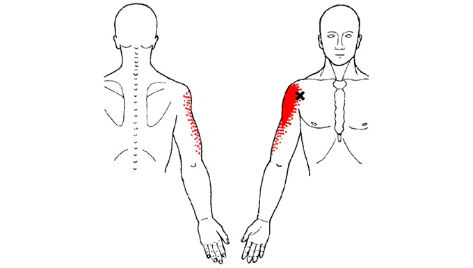 Deltoid Muscle Pain Causes, Treatment, And Prevention