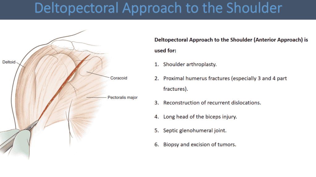 Approaches Category: Shoulder Approaches | OrthoFixar