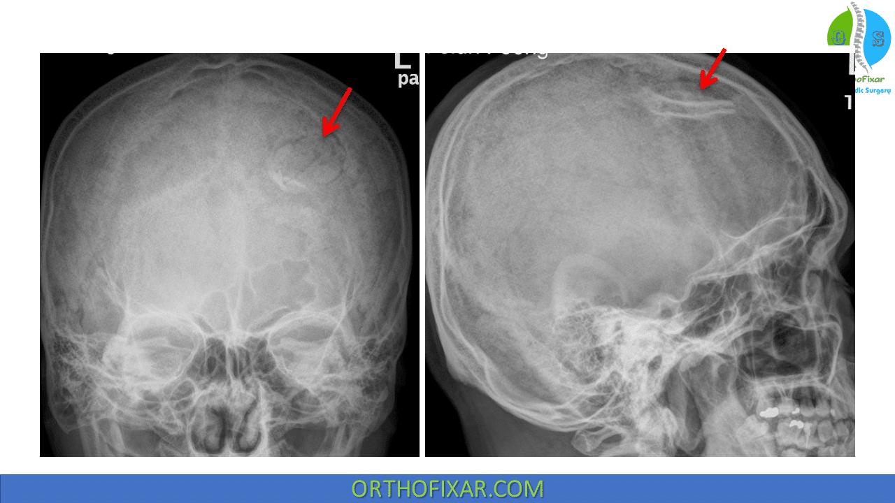 Skull Fracture Overview & Treatment | OrthoFixar