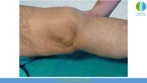 Knee Dislocation | Diagnosis & Treatment | OrthoFixar