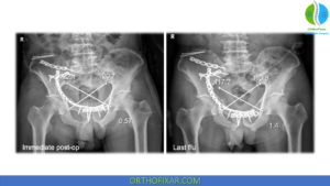 Sacroiliac Joint Dislocation - Full Review | OrthoFixar 2025