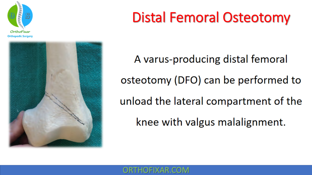 Distal Femoral Osteotomy Easily Step-By-Step | OrthoFixar