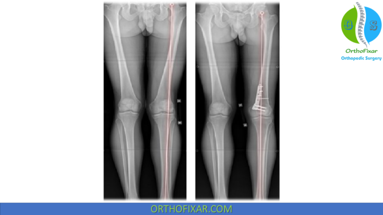 Distal Femoral Osteotomy Easily Step-By-Step | OrthoFixar
