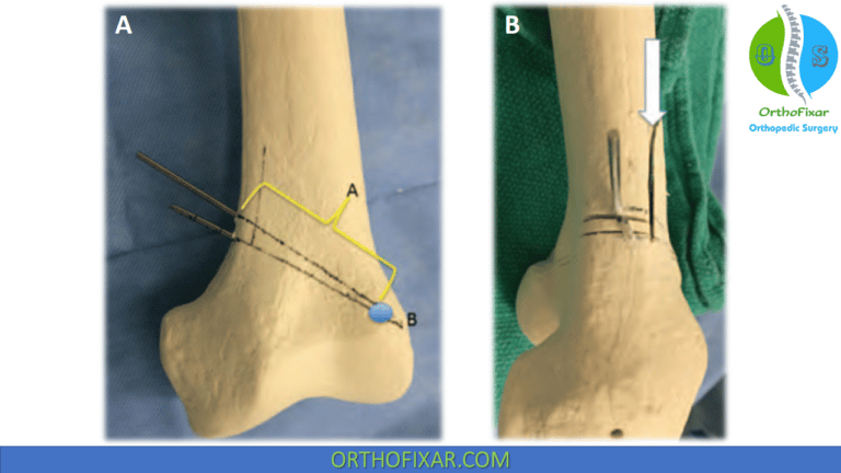 Distal Femoral Osteotomy Easily Step-By-Step | OrthoFixar