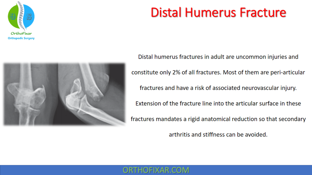 Distal Humerus Fracture | OrthoFixar