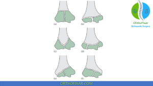 Distal Humerus Fracture