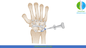 Wrist Injection Technique Easily Step-By-Step | OrthoFixar