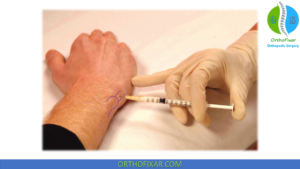 Wrist Injection Technique Easily Step-By-Step | OrthoFixar