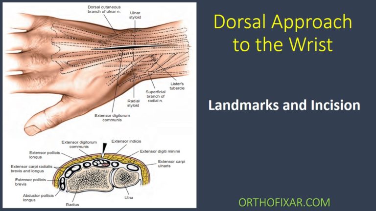 Dorsal Approach To The Wrist Easily Explained | OrthoFixar
