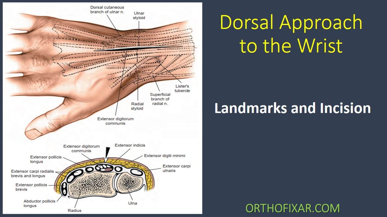 Dorsal Approach To The Wrist Easily Explained | OrthoFixar