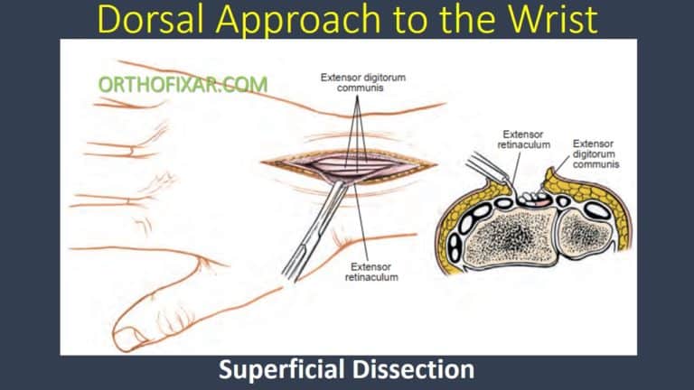 Dorsal Approach To The Wrist Easily Explained | OrthoFixar