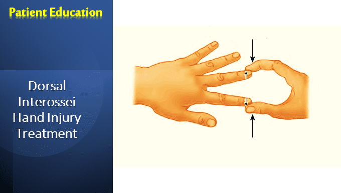 Dorsal Interossei Hand Injury Treatment | OrthoFixar