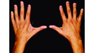 Dorsal Interossei Hand Injury Treatment | OrthoFixar