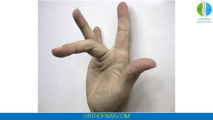 Egawa Sign Test For Ulnar Nerve Function