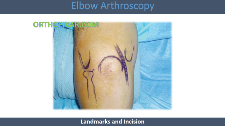 Elbow Arthroscopy • Easy Tutorial • OrthoFixar 2025
