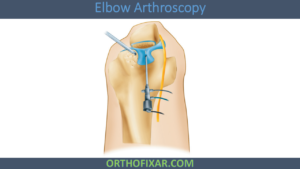 Elbow Arthroscopy • Easy Tutorial • OrthoFixar 2026