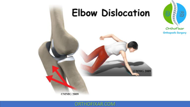 Elbow Dislocation Easy Explained | OrthoFixar 2025