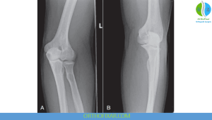 Elbow X-ray Views