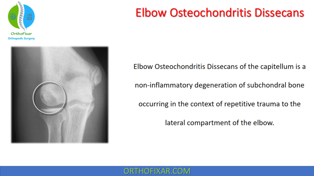 Elbow Osteochondritis Dissecans | OrthoFixar