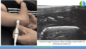 Elbow Ultrasound Imaging | OrthoFixar