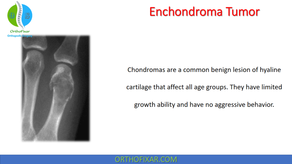 Chondroma | OrthoFixar 2025