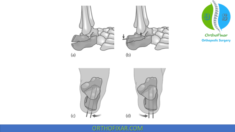 Calcaneus Fracture: Symptoms, Classification, Imaging & Treatment