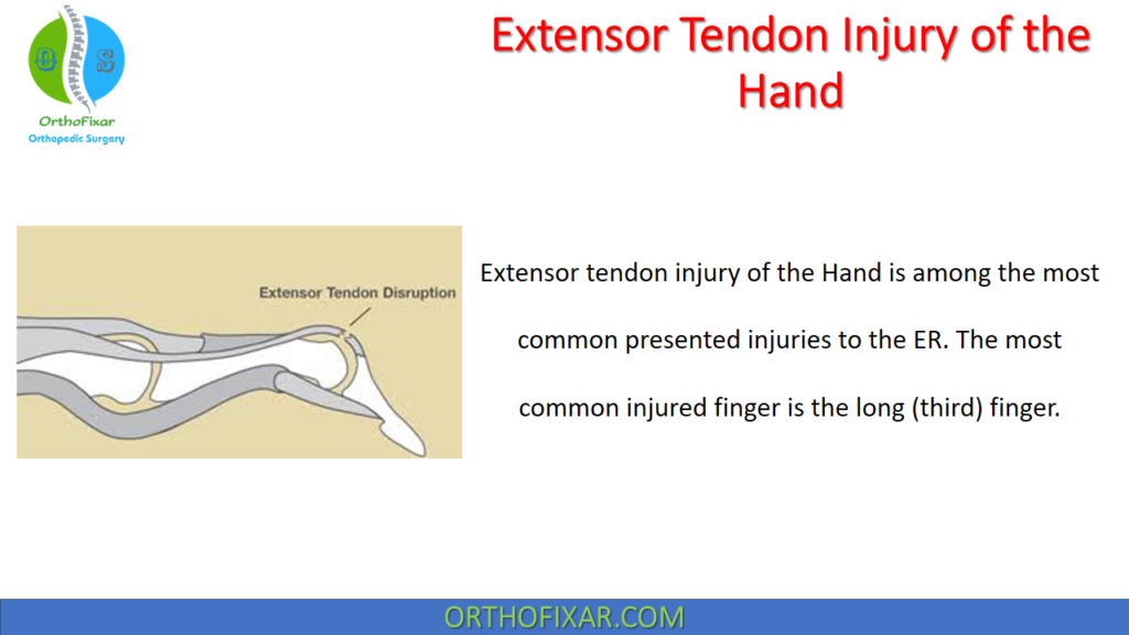 Extensor Tendon Injury Of The Hand | OrthoFixar 2025