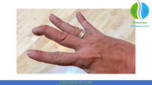 Extensor Tendon Injury Of The Hand | OrthoFixar 2026