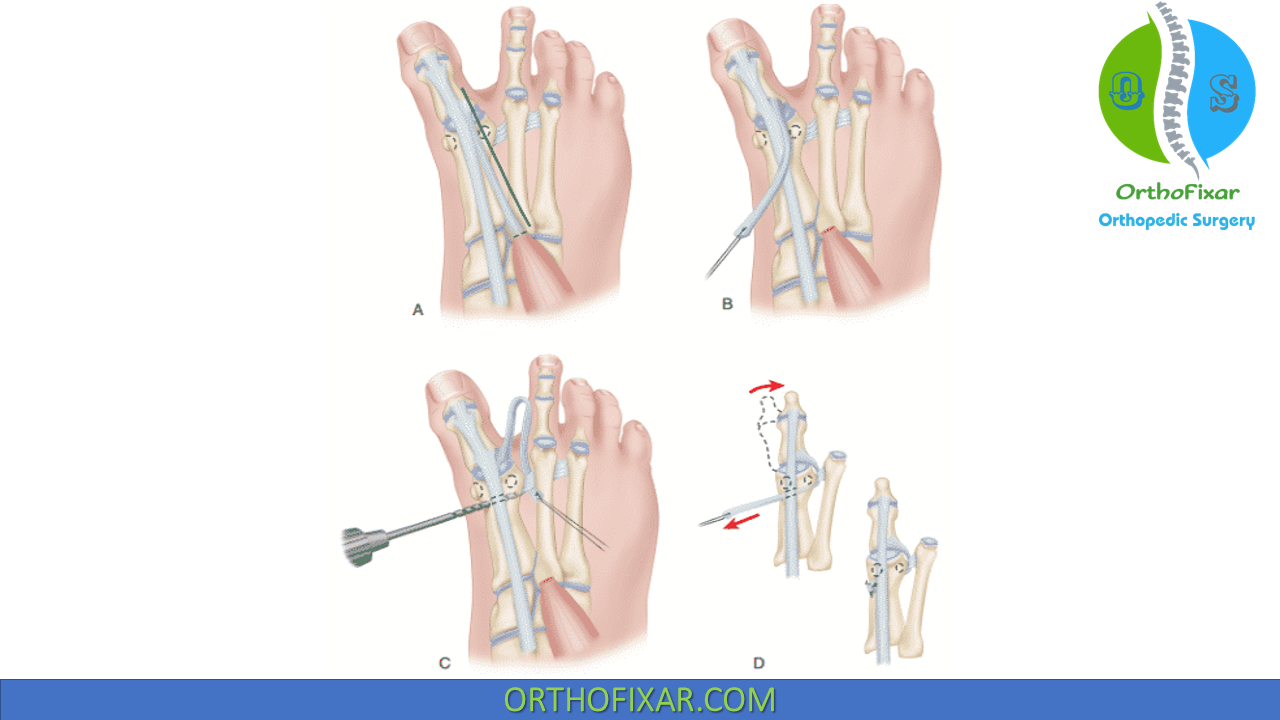 Hallux Varus - Easy Explained | OrthoFixar 2025