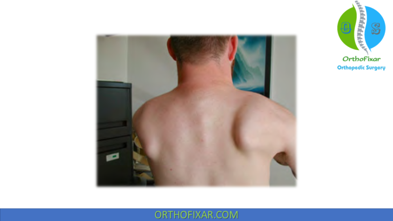 Facioscapulohumeral Dystrophy FSHD