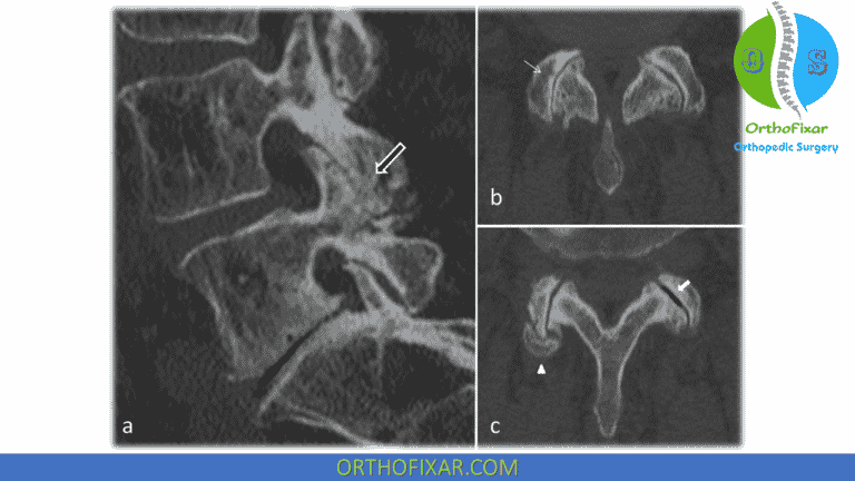 Facet Joint Dysfunction | OrthoFixar